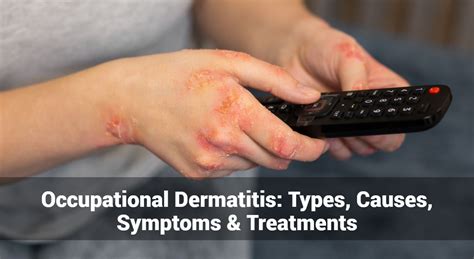 Occupational Dermatitis Types Causes Symptoms And Treatments Eczemaless