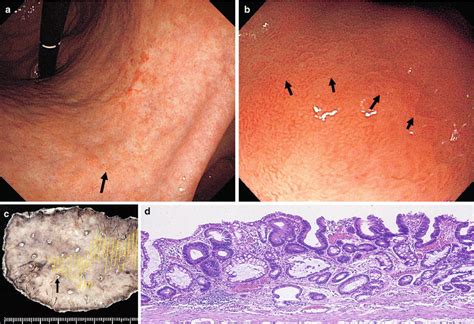 Endoscopy For Early Gastric Cancer At Julie Knight Blog