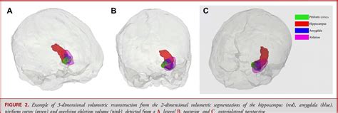 Figure 1 From Piriform Cortex Ablation Volume Is Associated With