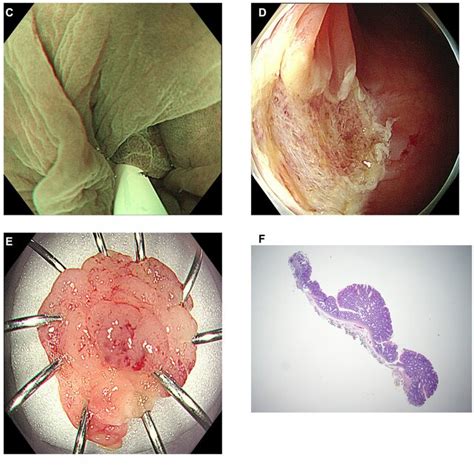 A Case Of Modified Underwater Endoscopic Mucosal Resection A