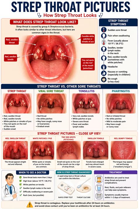 Strep Throat Pictures A Doctors Visual Guide On What To Look For