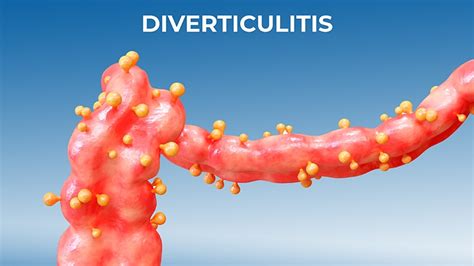 Surgery For Recurrent Diverticulitis Boosts Qol