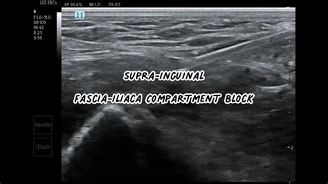 Supra Inguinal Fascia Iliaca Block Sifi Block Youtube