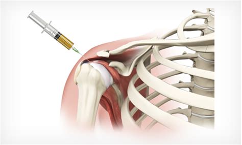 Studies Show That Stem Cells Injections Are An Effective Treatment For