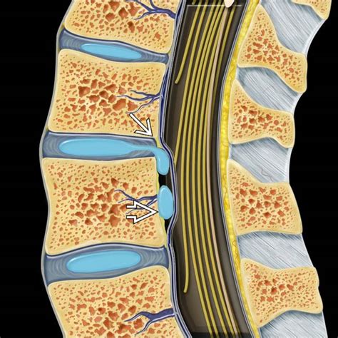 Nomenclature Of Degenerative Disc Disease Radiology Key