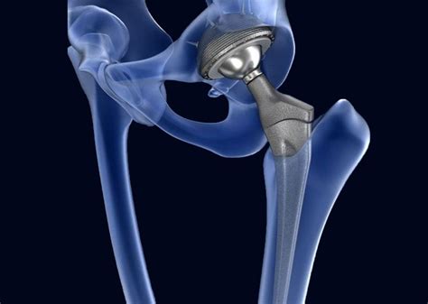 Ревизионное эндопротезирование тазобедренного сустава