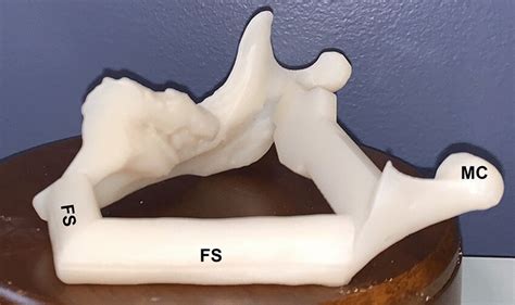 3d Printed Model Of Planned Fibular Reconstruction Of Mandible The
