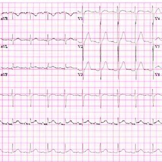 Electrocardiogram Showing Widespread ST Elevation And PR Depression Download Scientific Diagram