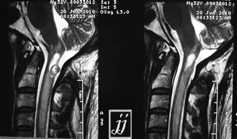 C Cord Hemangioblastoma Radiopaedia