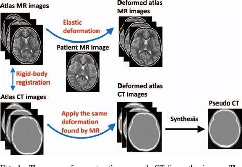 Figure From MRI Based Treatment Planning With Pseudo CT Generated Through Atlas Registration