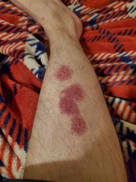 Are These Bed Bug Bites R Bugbites