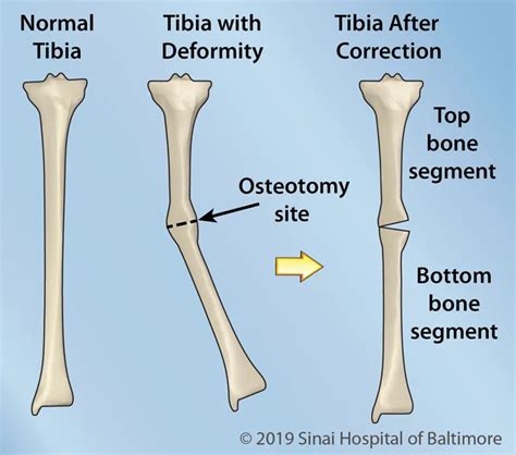 Deformity Correction The Process International Center For Limb