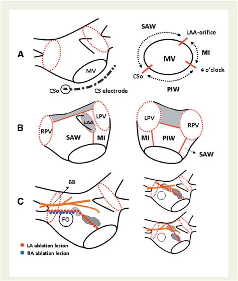 Figure From Peri Mitral Atrial Flutter Personalized Ablation Strategy Based On Arrhythmogenic
