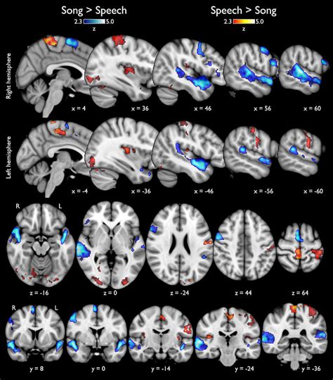 Statistical Activation Maps For Differences Between Vocal Music And