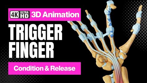 Finger Locked Or Stuck In A Bent Position Understanding Trigger Finger 4k 3d Animation Youtube