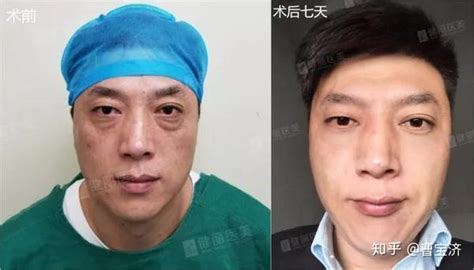 科普 泪沟类型分不清难怪你的泪沟花了10年还去不掉 知乎