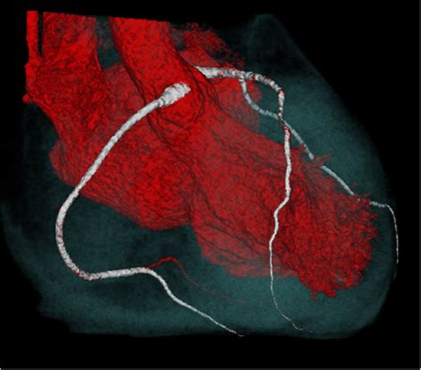 Three Dimensional Reconstruction Of The Computerized Tomography Scan Download Scientific