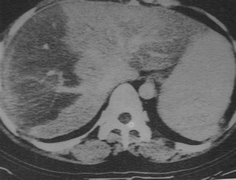 脂肪肝b超影像图 肝脏图片 中国脂肪肝防治与康复网
