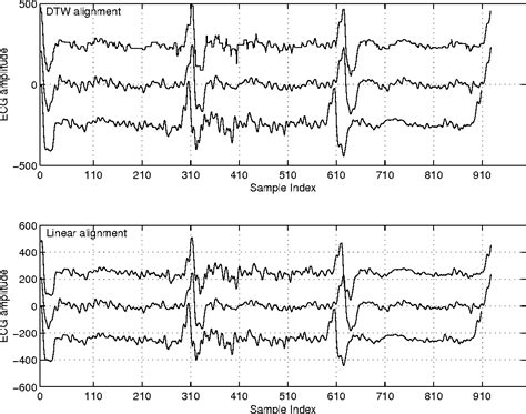 Figure 3 From A Single Lead Ecg Enhancement Algorithm Using A Regularized Data Driven Filter