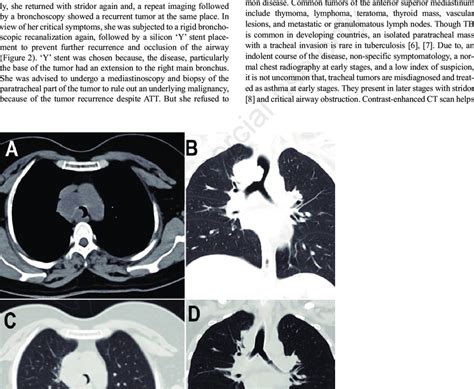 Ct Scan Of Lungs Tumor Shown In Axial View A Mediastinal Window B Download Scientific