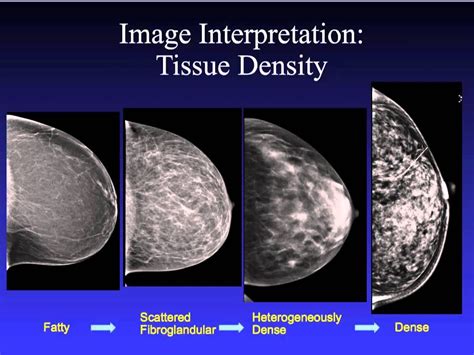 Breast Radiology Center Mammography Breast Mri Vrogue Co