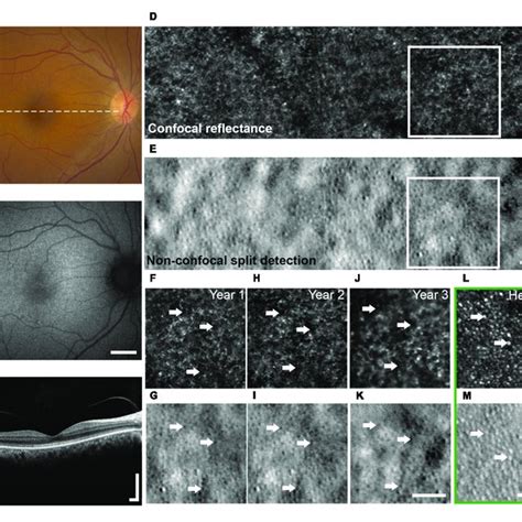 Multimodal Imaging Of A 65 Year Old Subject In Normal Chorioretinal