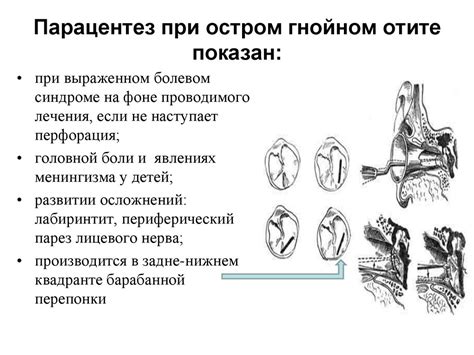 Заболевания наружного уха Острый средний отит мастоидит презентация онлайн