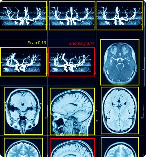 Anomaly Detection In Medical Image Analysis Imagevision Ai