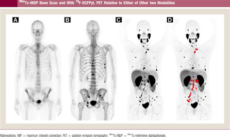 Bone Scan In Prostate Cancer