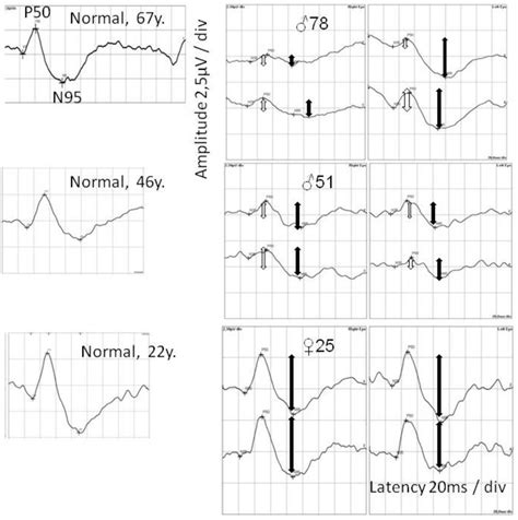 Pattern Electroretinography Perg In The Patients From Three Download Scientific Diagram