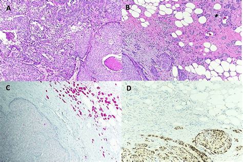 Lumpectomy Specimen Redemonstrated The Moderately Differentiated Download Scientific Diagram