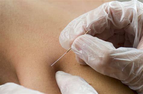 Trigger Point Dry Needling One On One Physical Therapy Atlanta