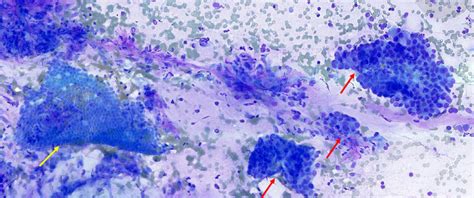Diff Quik Stained Slides 100x Magnification With Rapid On Site