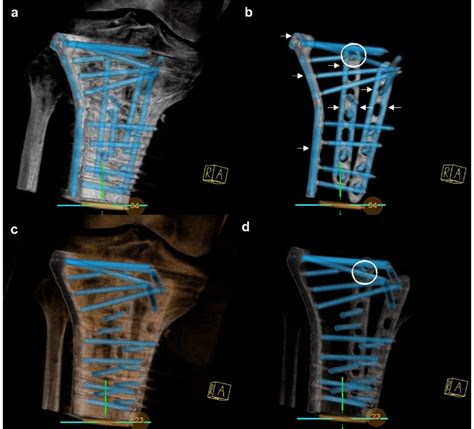 Implant Detection After Triple Plate Osteosynthesis Of A Tibial Head