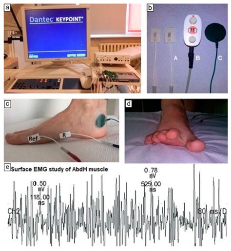Surface Electromyography