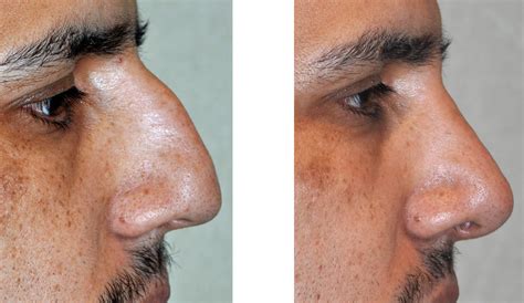 Plastic Surgerys Did You Know The Roman Nose And Rhinoplasty