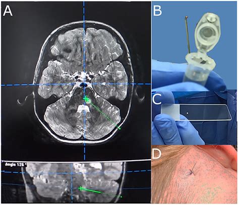 Stereotactic Biopsy