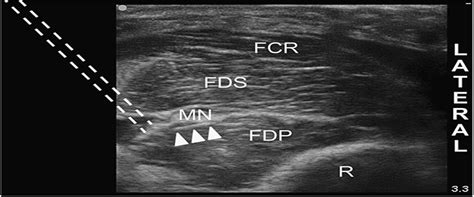 Ultrasound Guided Continuous Median Nerve Block To Facilitat The Clinical Journal Of Pain