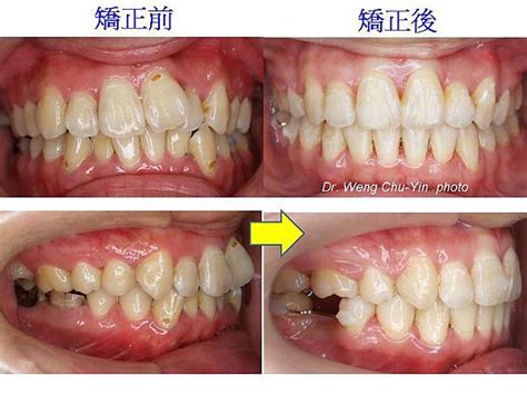 缺牙病例 矯正立正智齒。關閉大臼齒空隙。矯正專科翁竹音醫師－矯正專科 翁竹音醫師｜痞客邦