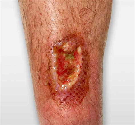 What Are The 5 Most Important Steps Of Skin Tear Management