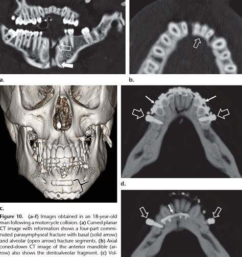 Types Of Mandibular Fracture Radiology