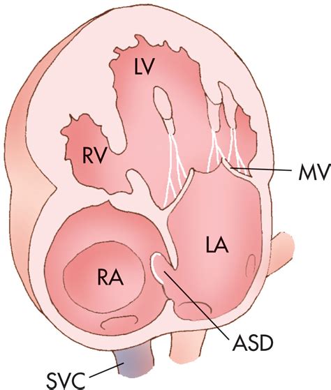 Fetal Echocardiography Congenital Heart Disease Clinical Tree