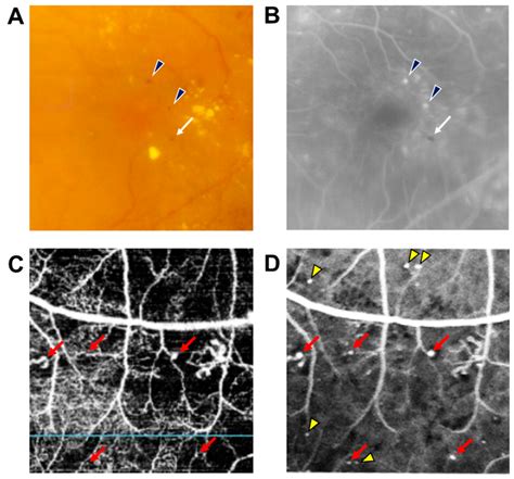 Role Of Microaneurysms In Diabetic Macular Edema Encyclopedia Mdpi