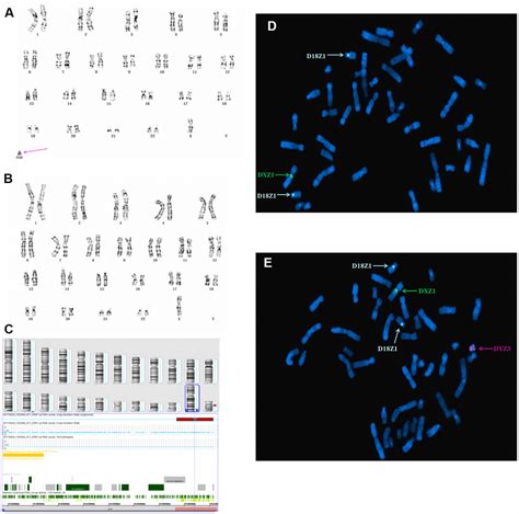 Prenatal Diagnosis And Molecular Cytogenetic Identification Of Small Supernumerary Marker