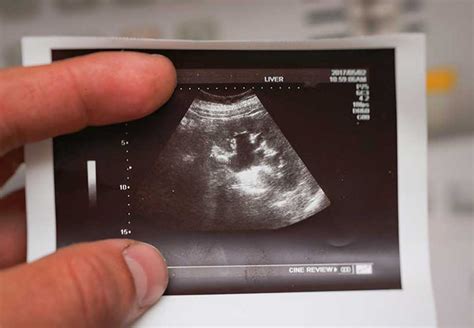 Ureteral Duplication Dr Heidi Stephany
