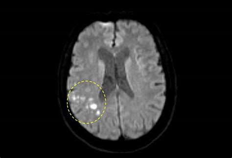 Acute Stroke Critical Diagnostic Findings