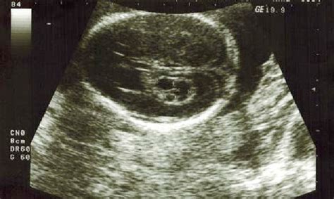 Figure 1 From Multiple Choroid Plexus Cysts A Case Report Semantic Scholar