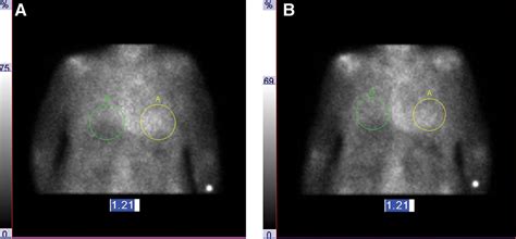 1 Hour Versus 3 Hour 99mtc Pyp Imaging To Evaluate Suspected Medicine
