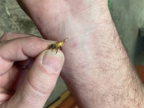 Bee Sting Therapy