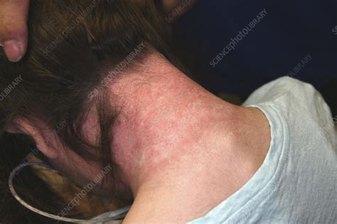 Dermatomyositis Stock Image C0606595 Science Photo Library